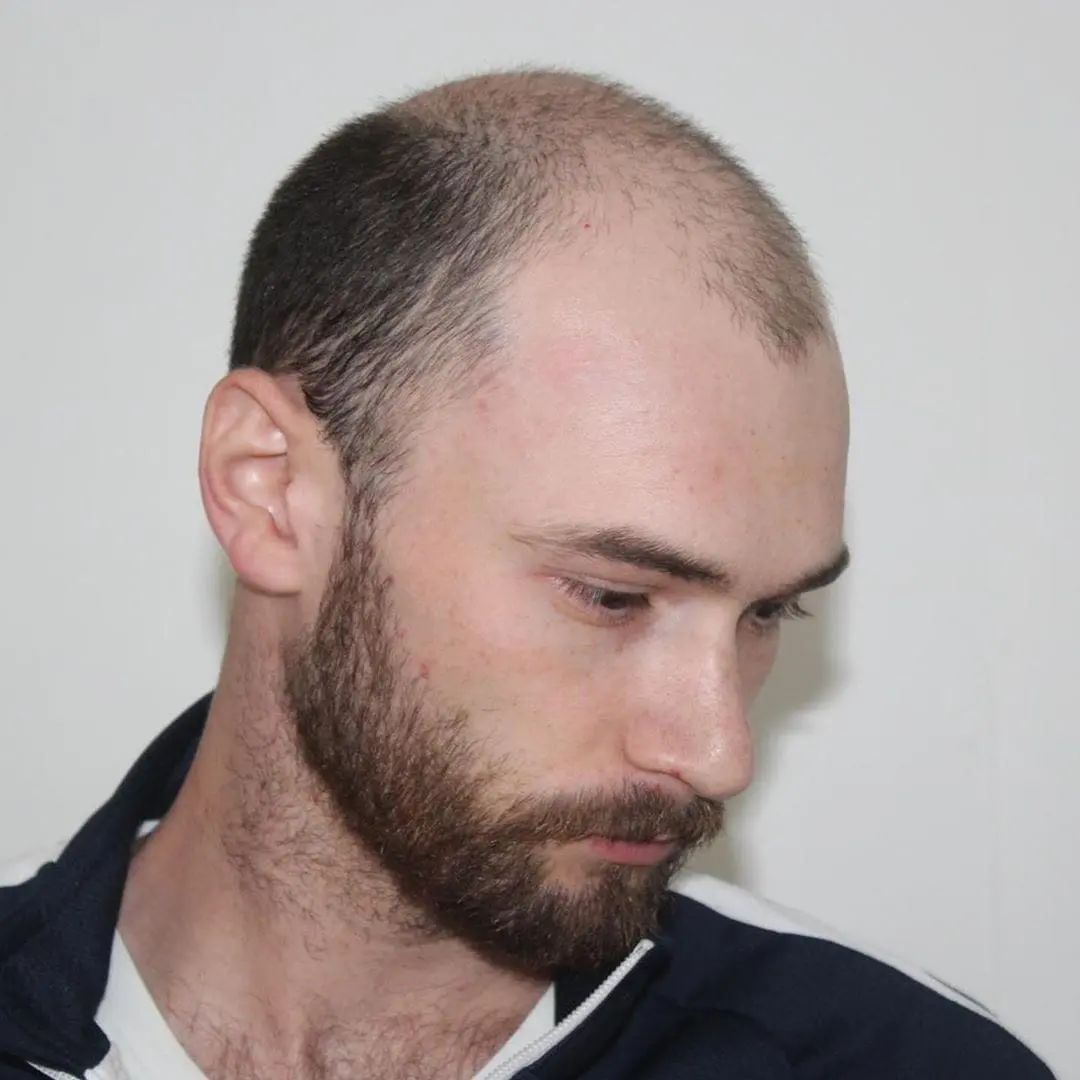 Male Pattern Baldness Real Me Smp